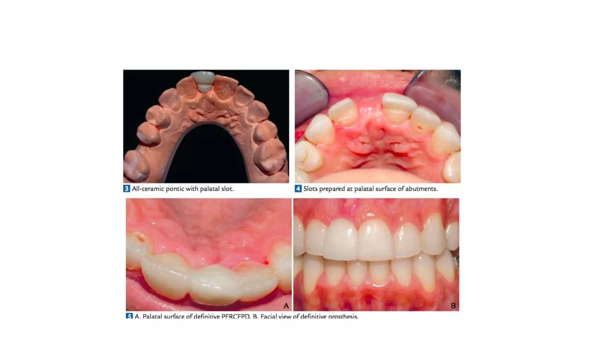 Fiber reinforced composite fixed prosthesis | PPTX