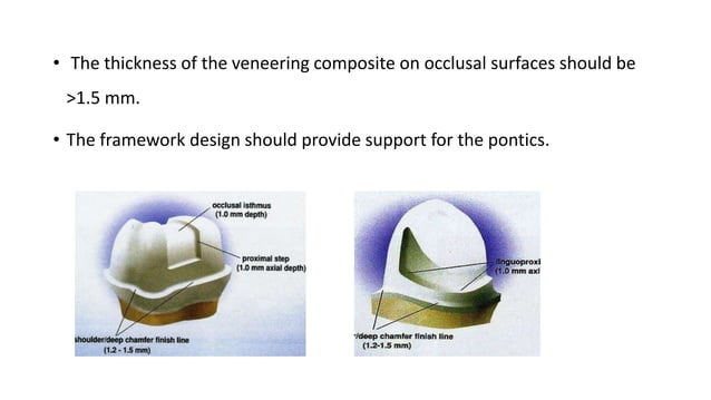 Fiber reinforced composite fixed prosthesis | PPTX