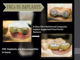 Fibre Odontology | PPT