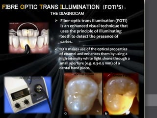 Fibre Odontology | PPT