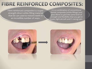 Fibre Odontology | PPT