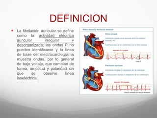Fibrilacion auricular | PPTX