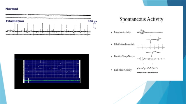 ABNORMAL NCV: FIBRILLATION POTENTIALS.pptx
