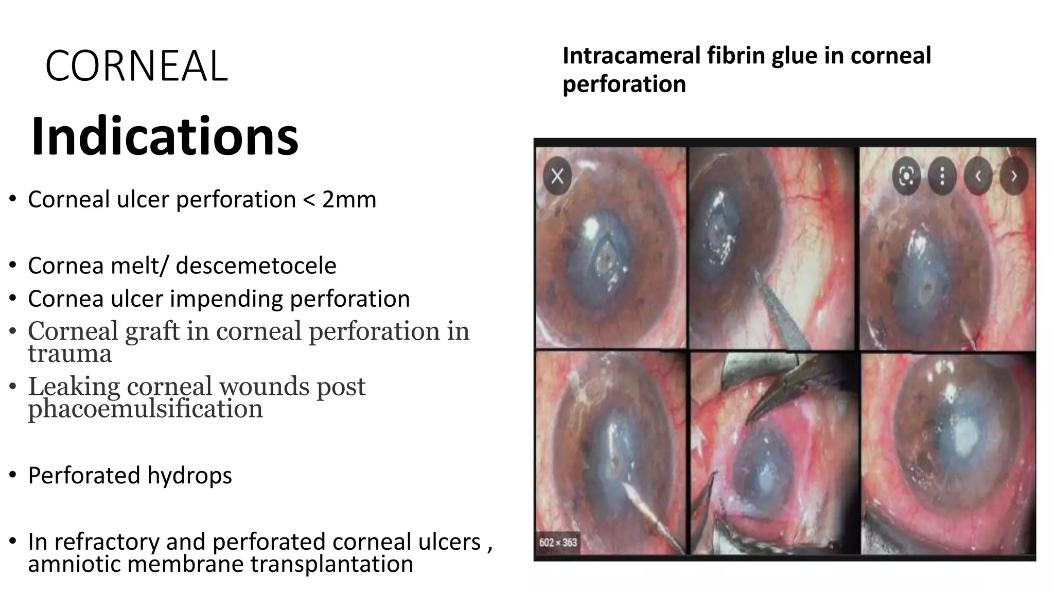 FIBRIN GLUE IN OPHTHALMOLOGY.pptx