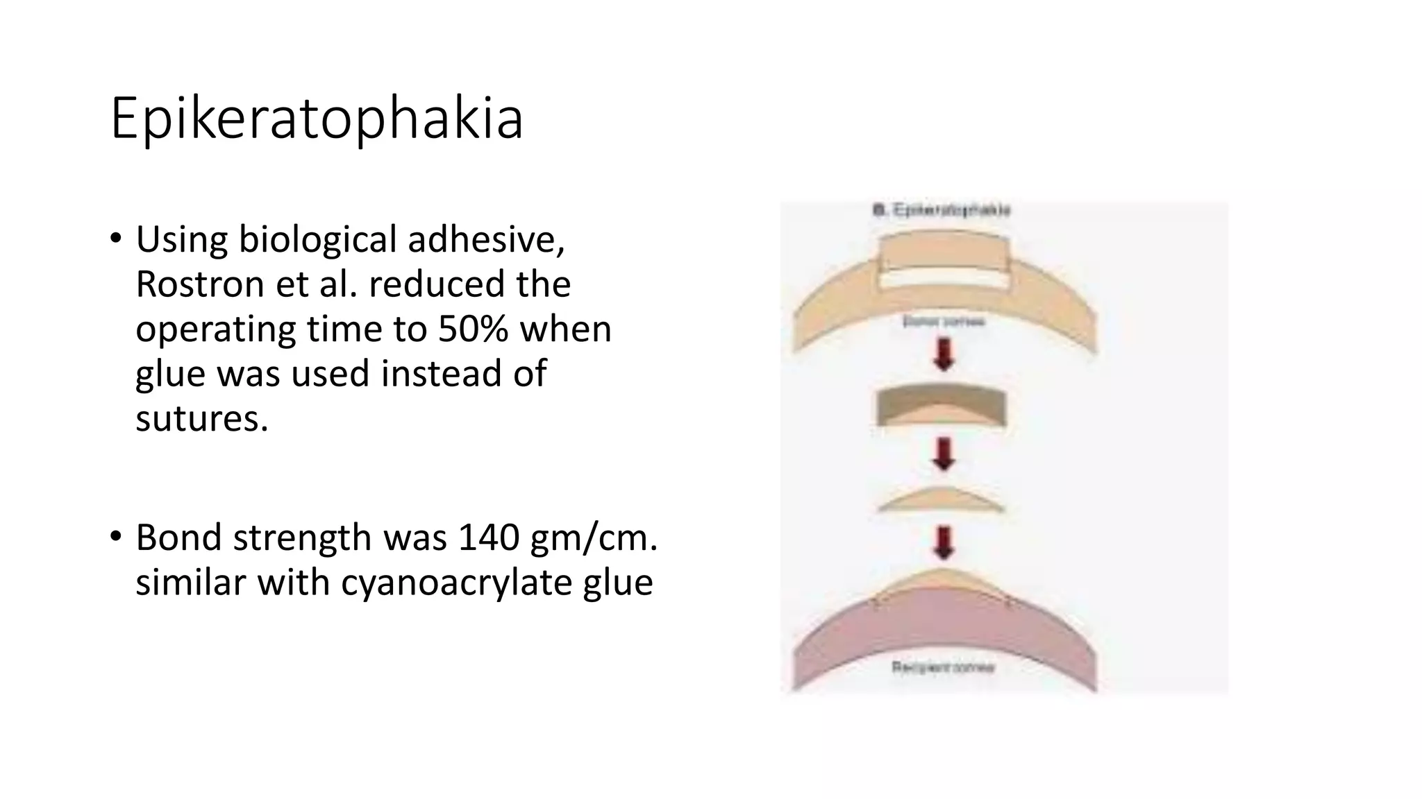 FIBRIN GLUE IN OPHTHALMOLOGY.pptx