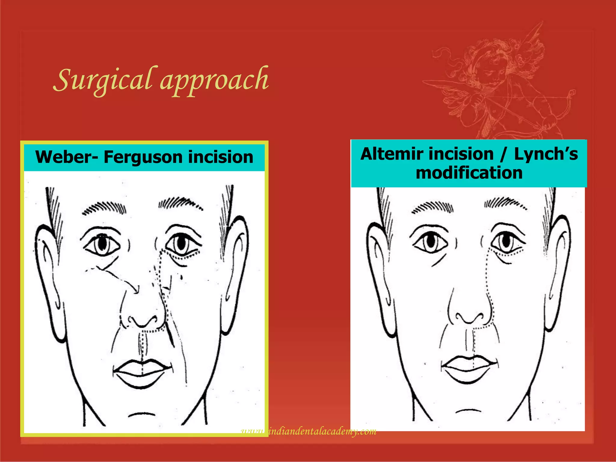 Fibro osseous lesions /certified fixed orthodontic courses by Indian ...