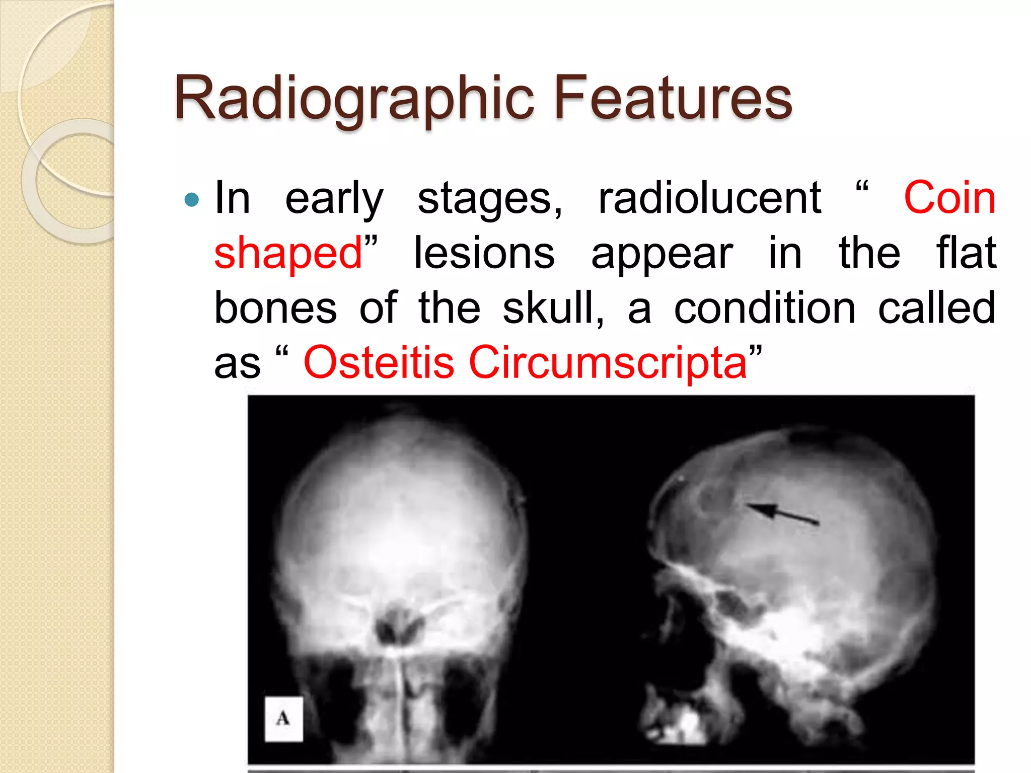 Fibro Osseous Lesions | PPTX