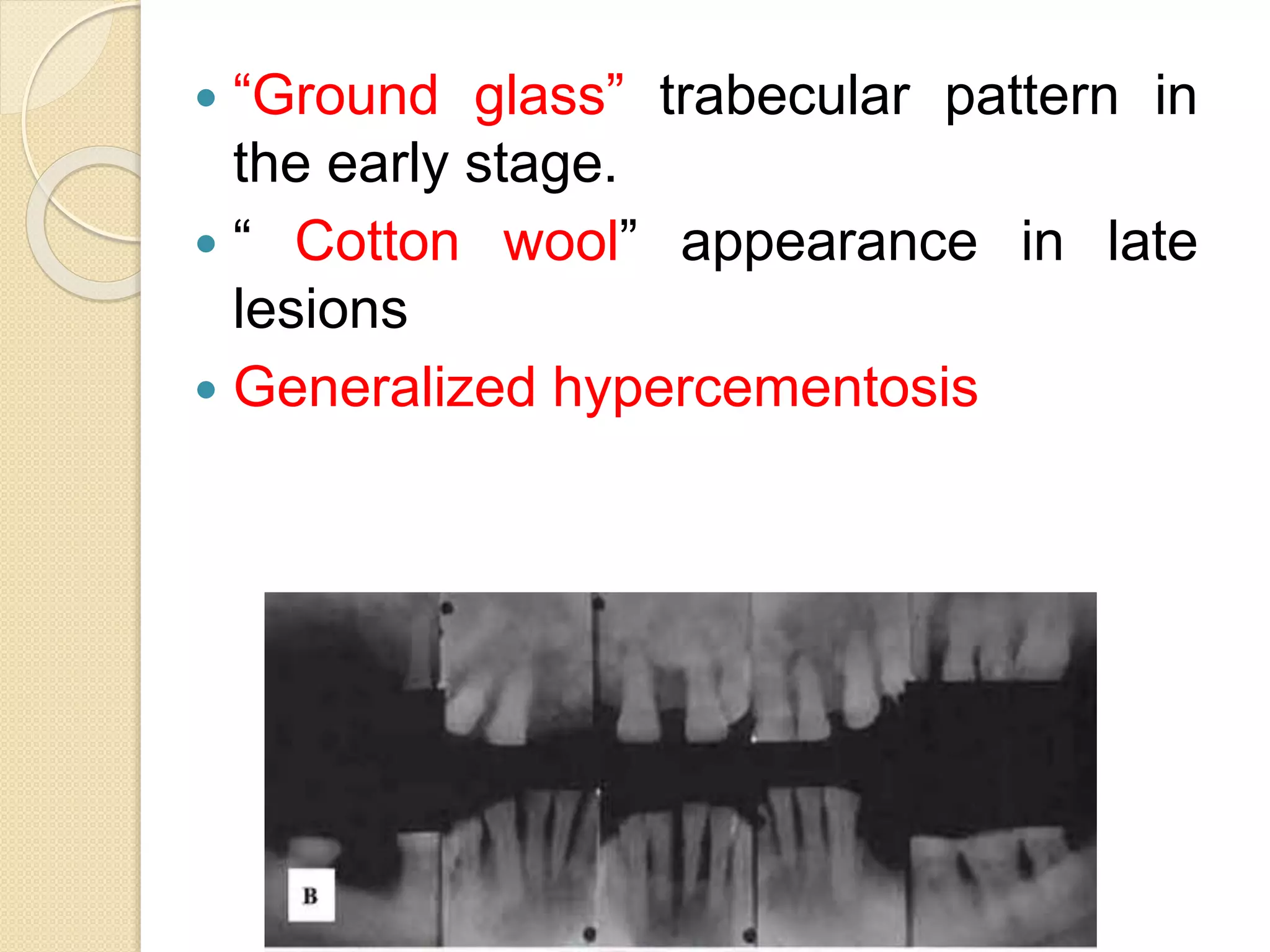Fibro Osseous Lesions | PPTX