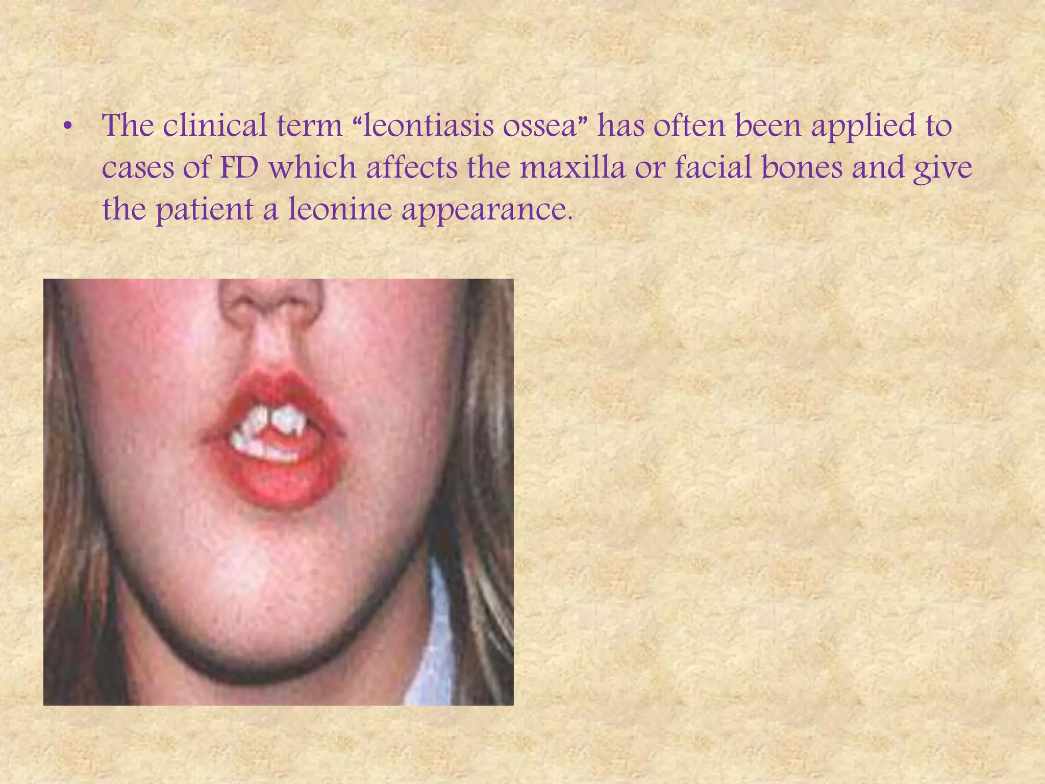 Fibro osseous lesions | PPTX