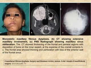 Fibro osseous lesions | PPTX