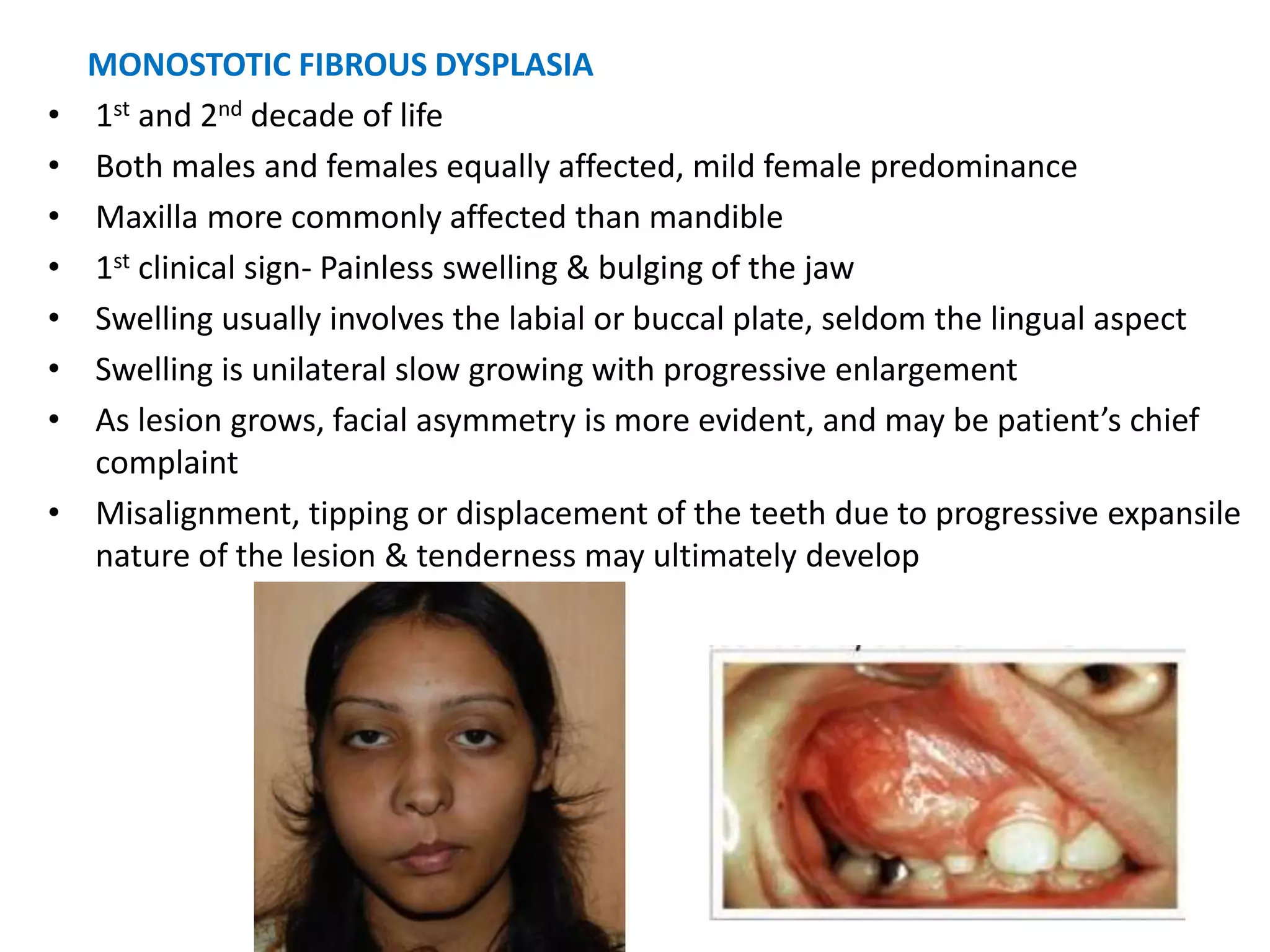 Fibro osseous lesions | PPTX