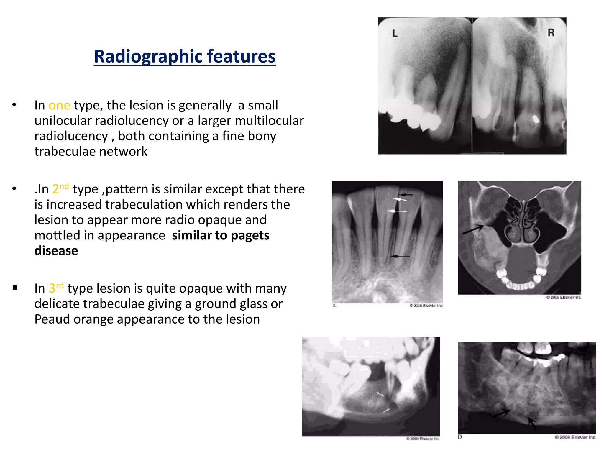 Fibro osseous lesions | PPTX