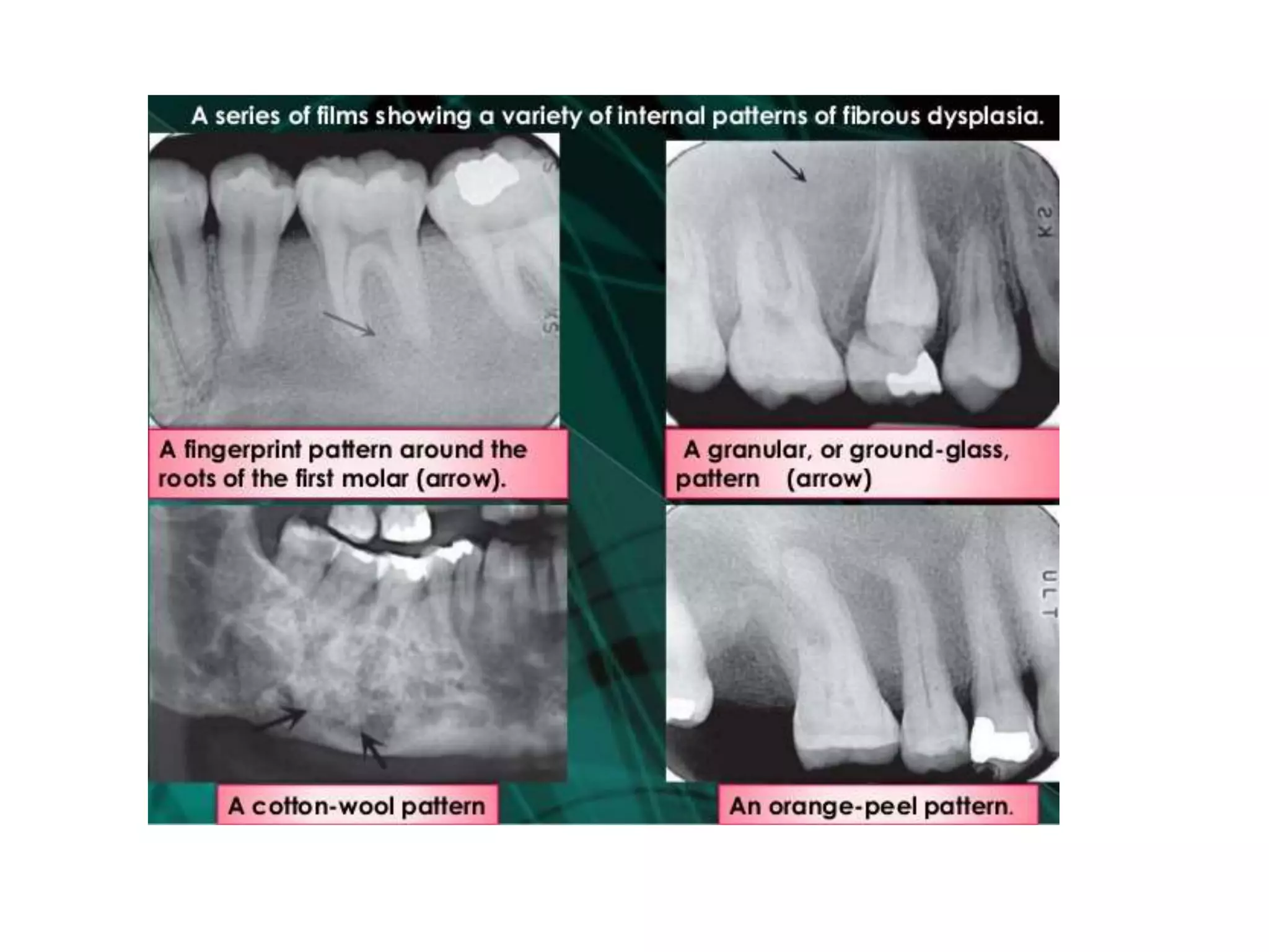 Fibro osseous lesions | PPTX