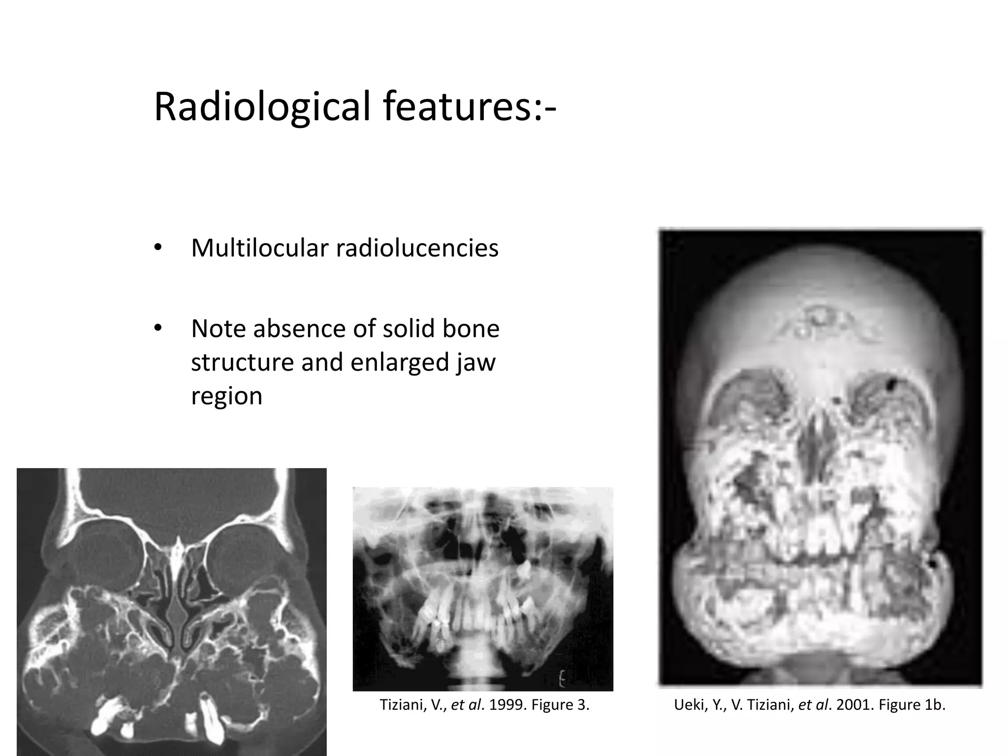 Fibro osseous lesions | PPTX