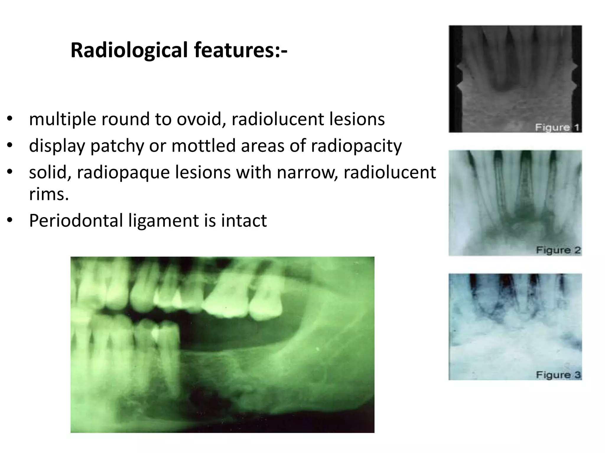 Fibro osseous lesions | PPTX