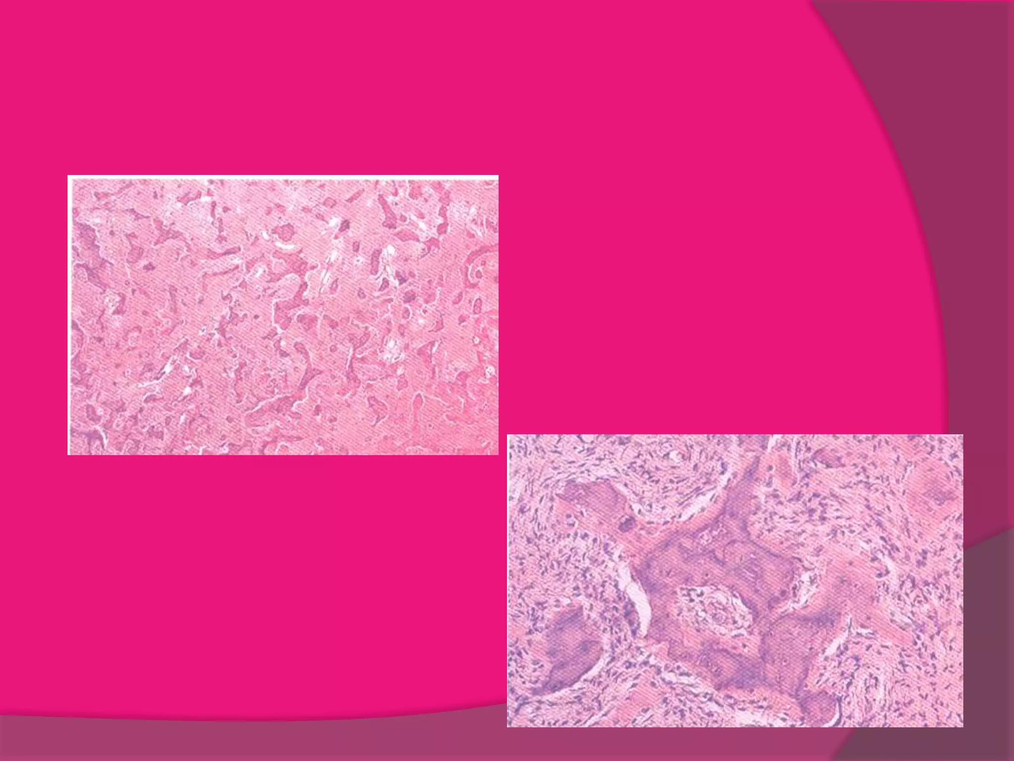 FIBRO-OSSEOUS LESIONS.ppt