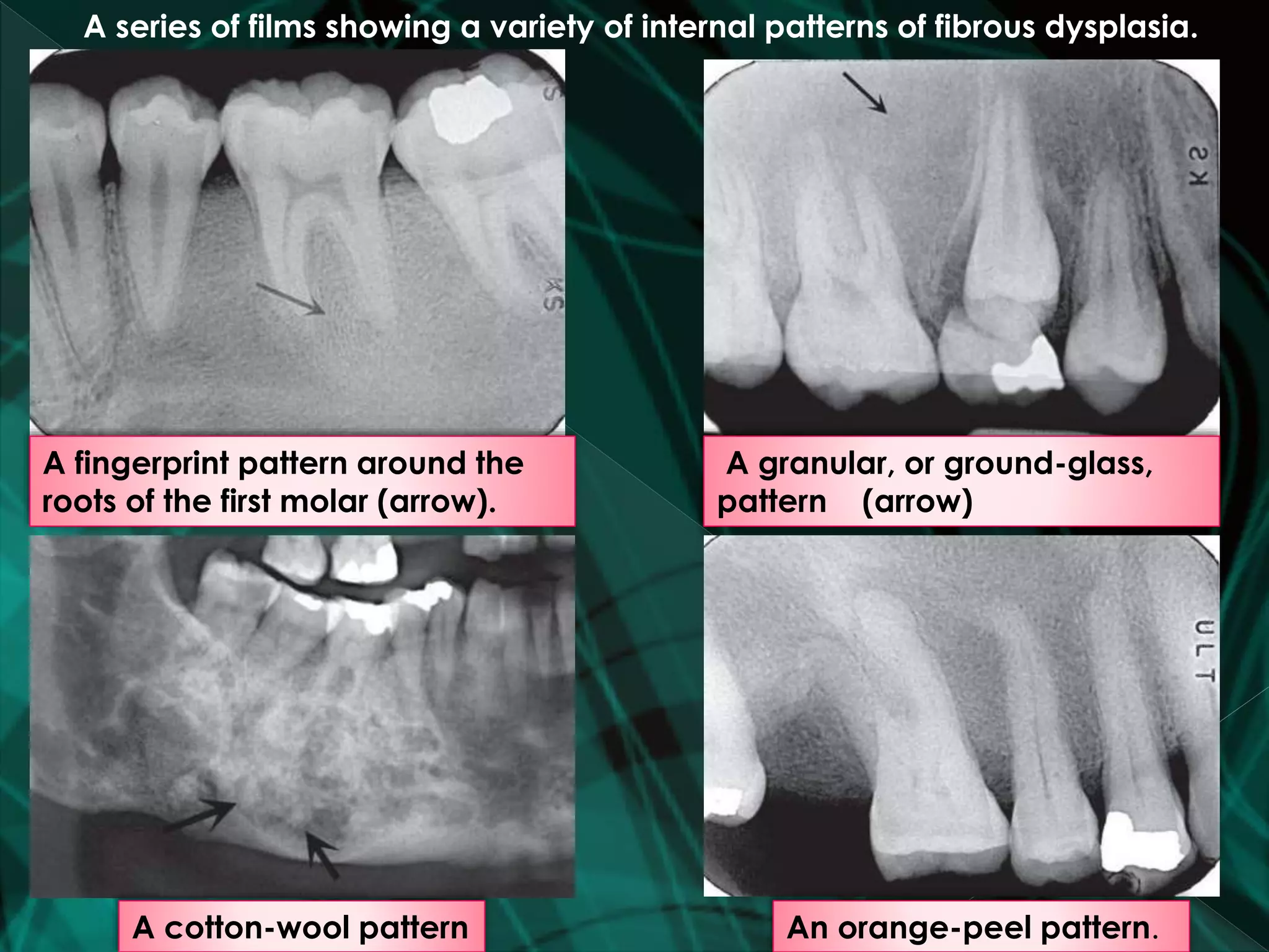 Fibro osseous lesions of jaw | PPTX