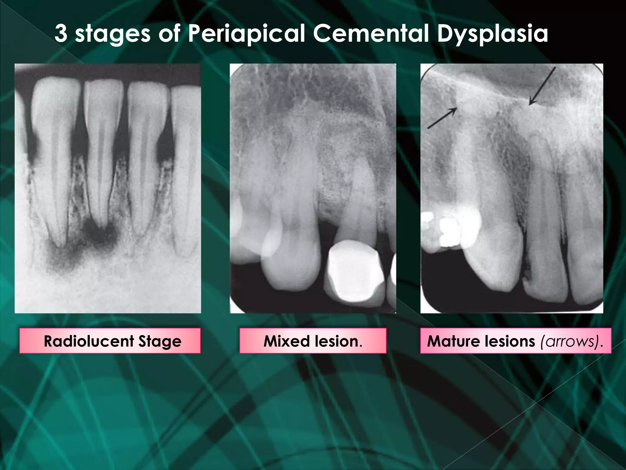 Fibro osseous lesions of jaw | PPTX