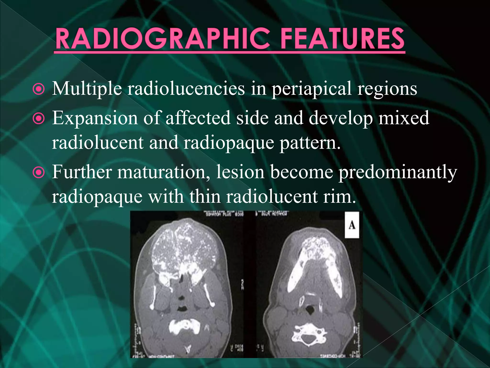 Fibro osseous lesions of jaw | PPTX