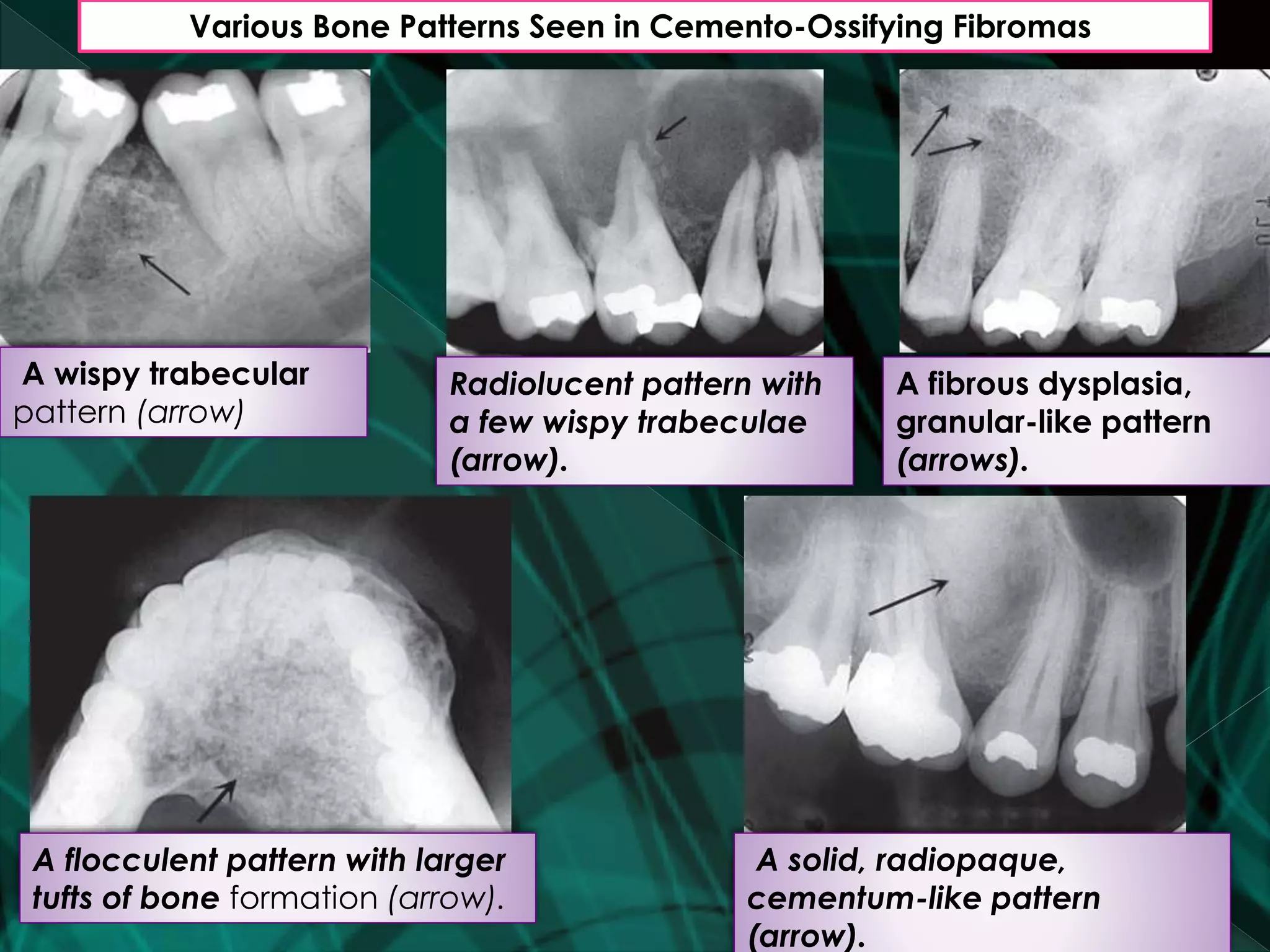 Fibro osseous lesions of jaw | PPTX