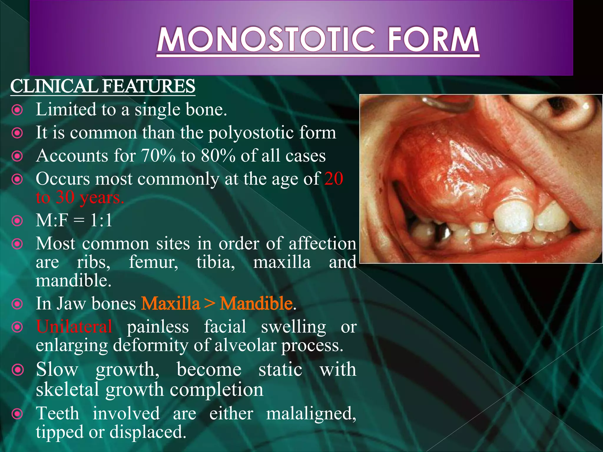 Fibro osseous lesions of jaw | PPTX