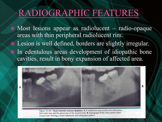 Fibro osseous lesions of jaw | PPTX
