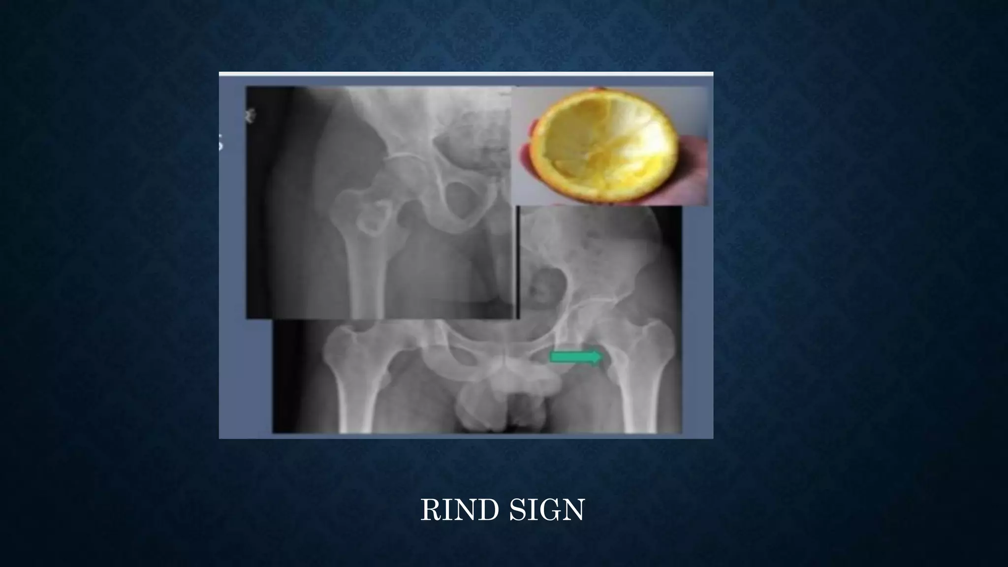 Fibro osseous lesions of the jaws | PPTX