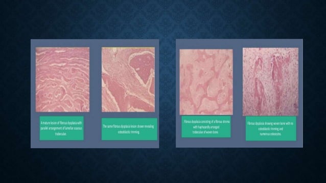 Fibro osseous lesions of the jaws | PPTX | Dental Health | Diseases and ...