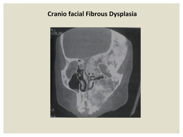 Fibro Osseous Lesions | PPT | Bone and Joint Conditions | Diseases and ...