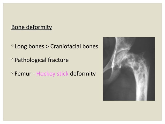 Fibro Osseous Lesions | PPT | Bone and Joint Conditions | Diseases and ...