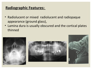 Fibro Osseous Lesions | PPT