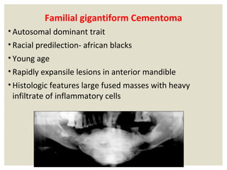 Gigantiform Cementoma