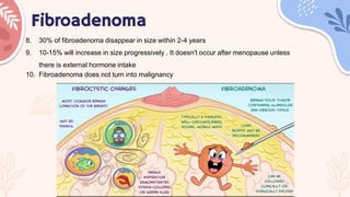 fibroadenoma.pptx