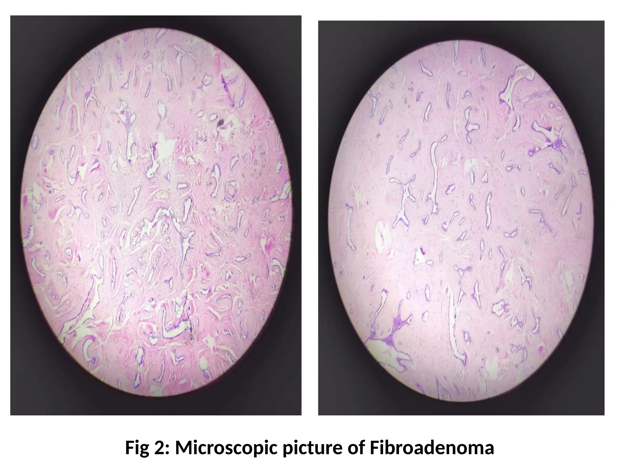 Fibroadenoma FIBROADENOMA BREAST .pptx