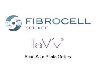 Fibrocell Power Point | PPTX