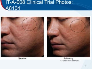 Fibrocell Power Point | PPTX
