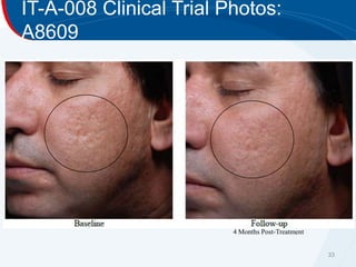 Fibrocell Power Point | PPTX