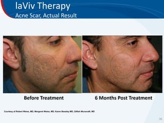 Fibrocell Power Point | PPTX
