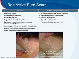 Fibrocell Power Point | PPTX