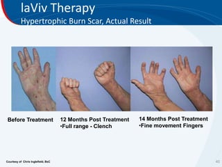 Fibrocell Power Point | PPTX