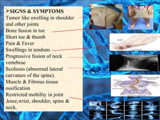 Stone Man Disease Symptoms