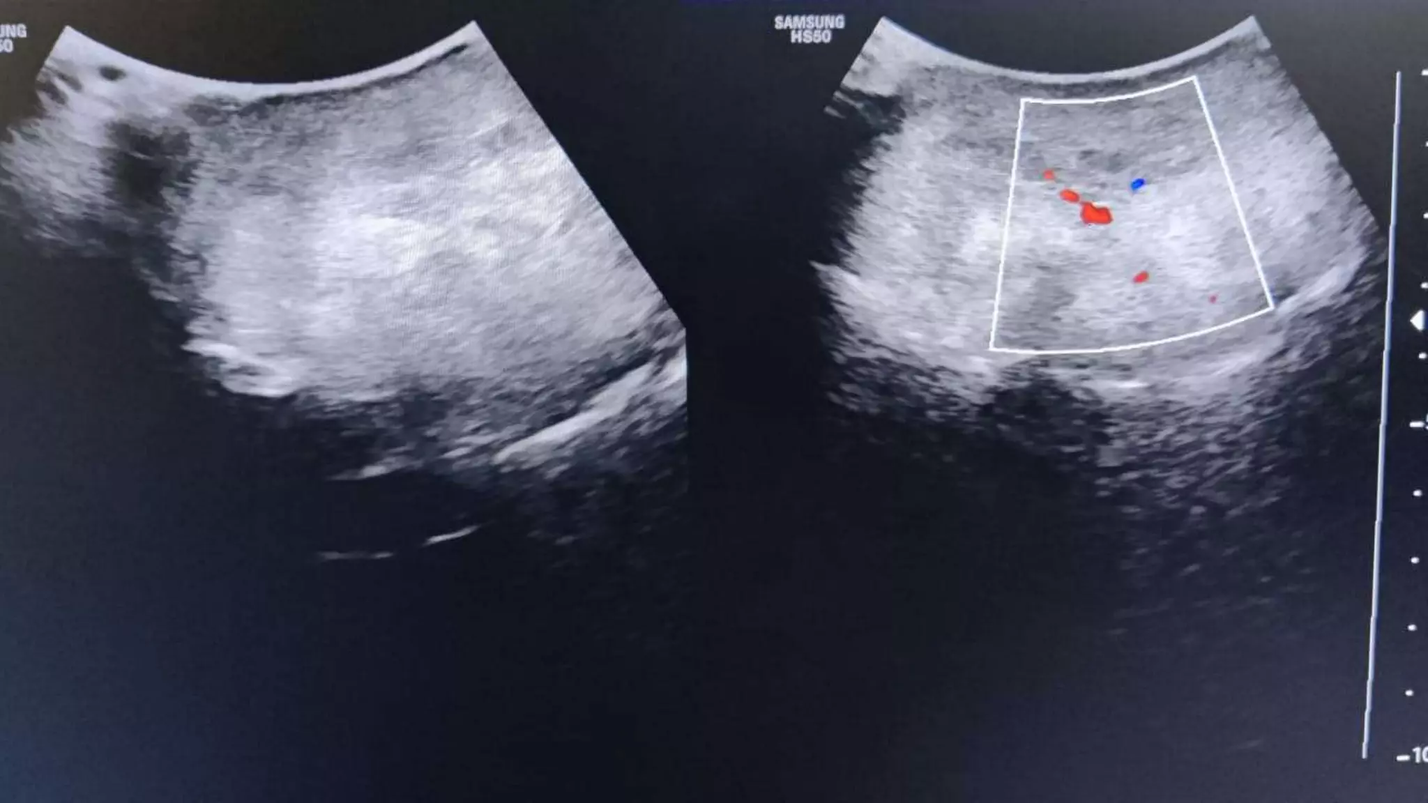 Fibroepithelial polyps.pptx