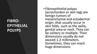 Fibroepithelial polyps.pptx