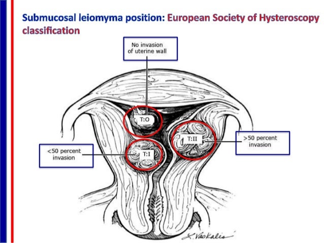 Uterine leiomyoma (fibroid)