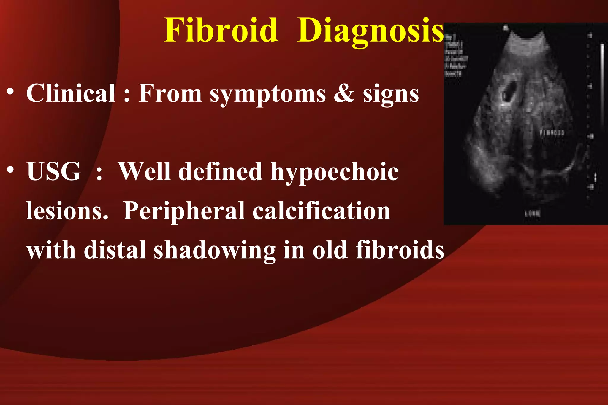 Fibroid uterus | PPT