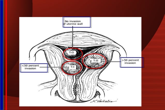 Fibroid uterus | PPT | Free Download