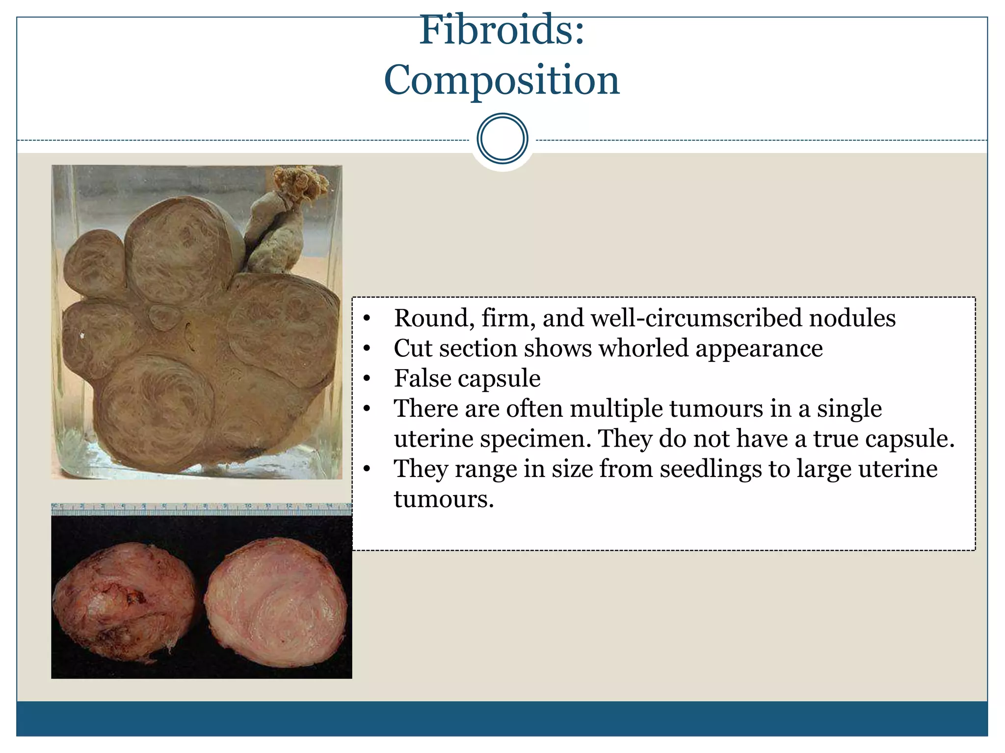 Uterine Fibroid / Uterine Leiomyoma / Indore Infertility | PPTX