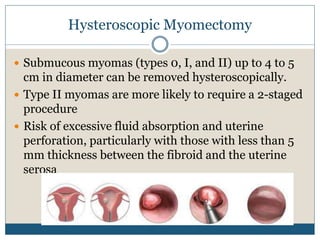 Uterine Fibroid / Uterine Leiomyoma / Indore Infertility | PPTX