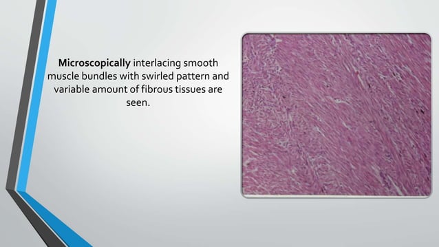 FIBROID%20UTERUS%20FINAL%20PPT copy.pptx | Pregnancy | Reproductive Health