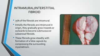 FIBROID%20UTERUS%20FINAL%20PPT copy.pptx